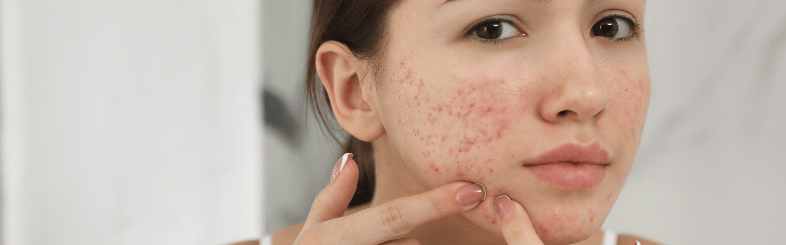 Acne | Oorzaak en behandeling | Boots Apotheek