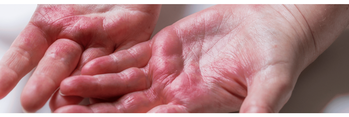 Handeczeem | Tips tegen de roodheid, jeuk en droogheid