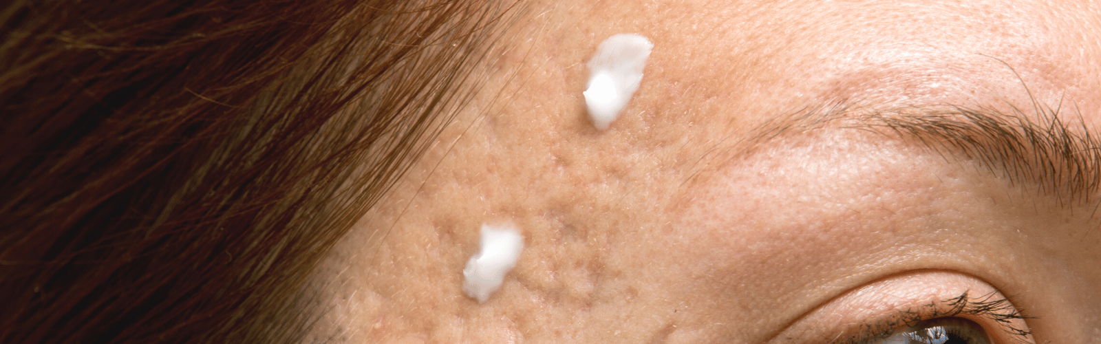 Acne | Oorzaak en behandeling | Boots Apotheek - Boots Nederland