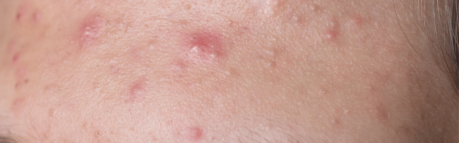 Acne | Oorzaak en behandeling | Boots Apotheek - Boots Nederland