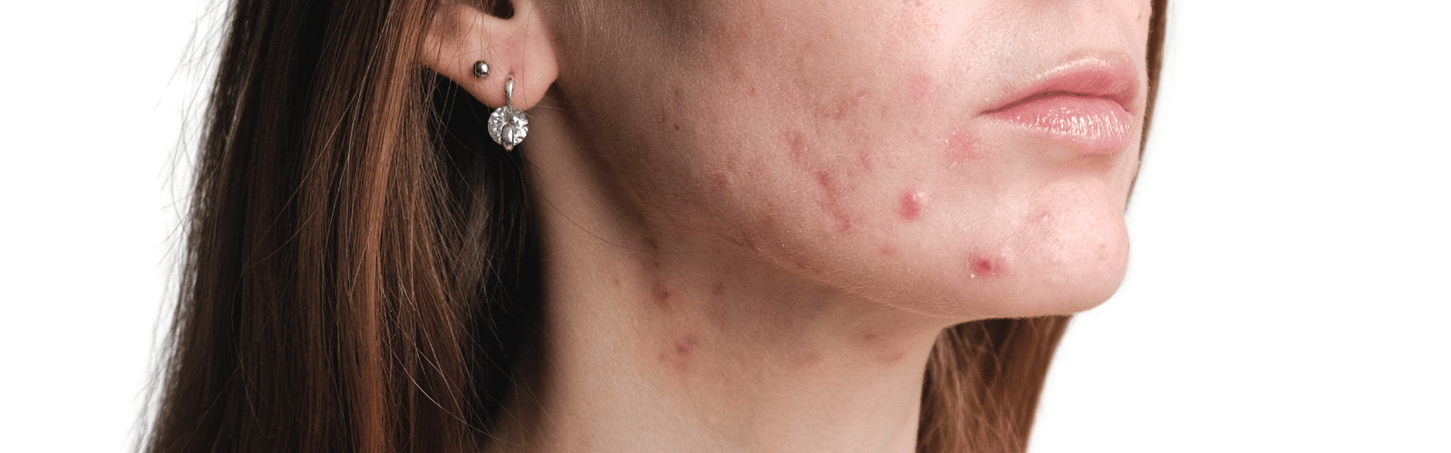 Acne | Oorzaak en behandeling | Boots Apotheek - Boots Nederland