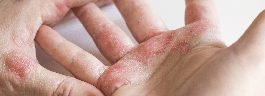 Blaasjes eczeem | Oorzaak en behandeling | Boots Apotheek - Boots Nederland