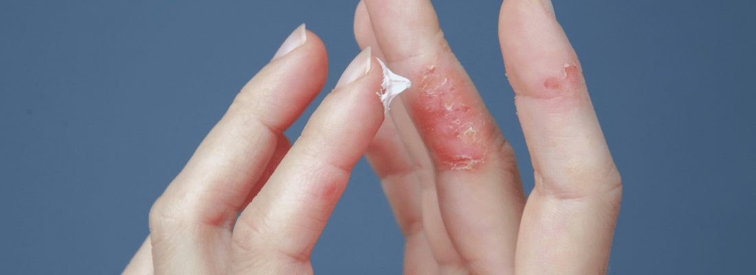 Blaasjes eczeem | Oorzaak en behandeling | Boots Apotheek - Boots Nederland