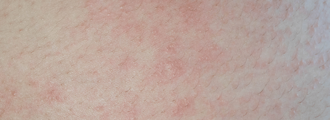 Blaasjes eczeem | Oorzaak en behandeling | Boots Apotheek - Boots Nederland