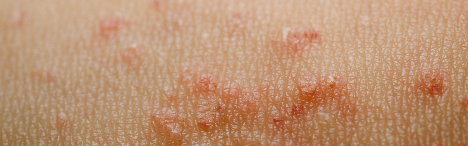 Blaasjes eczeem | Oorzaak en behandeling | Boots Apotheek - Boots Nederland