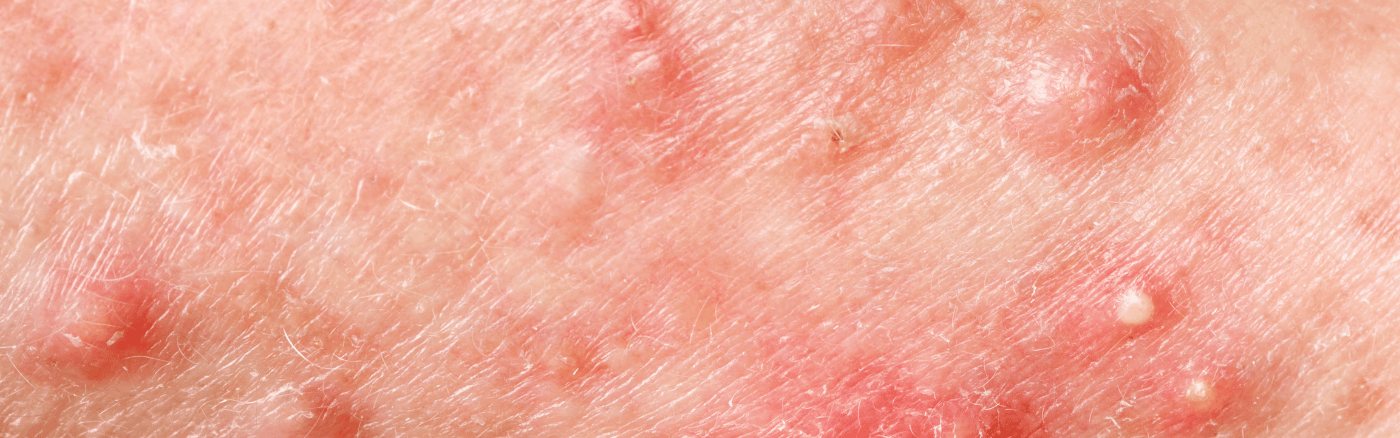 Acne | Oorzaak en behandeling | Boots Apotheek