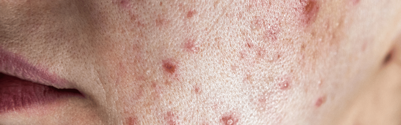 Acne | Oorzaak en behandeling | Boots Apotheek