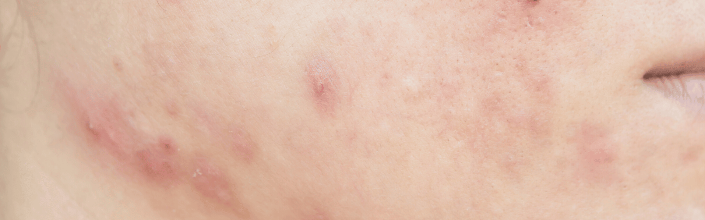 Acne | Oorzaak en behandeling | Boots Apotheek