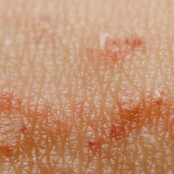 Blaasjes eczeem | Oorzaak en behandeling | Boots Apotheek