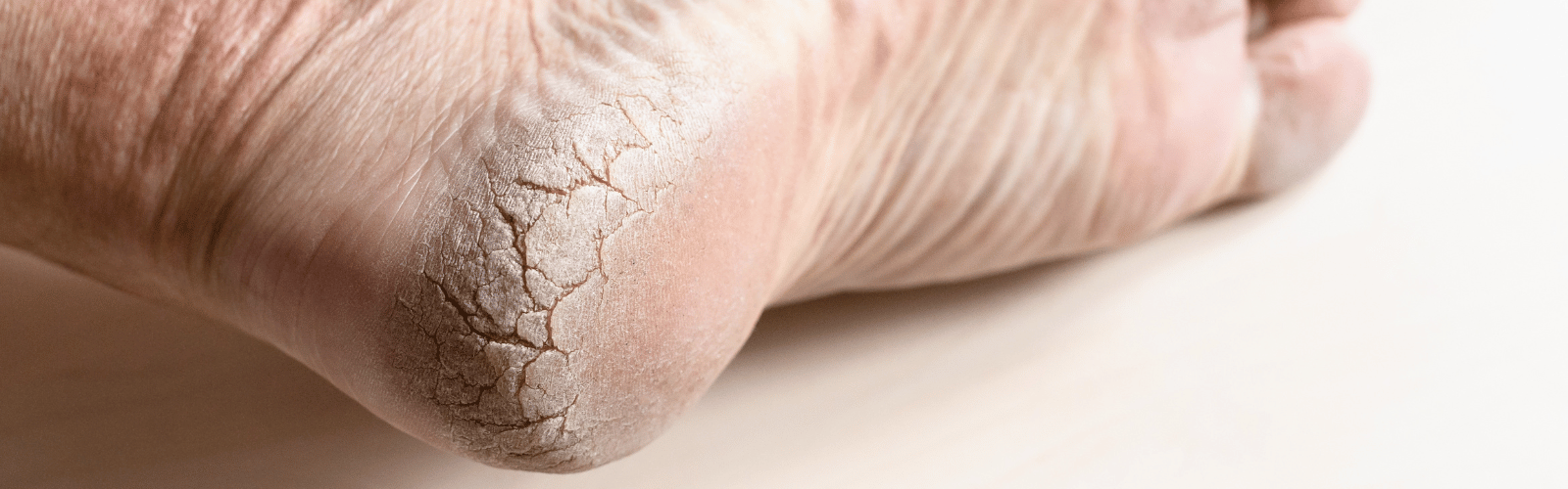 Blaasjes eczeem | Oorzaak en behandeling | Boots Apotheek