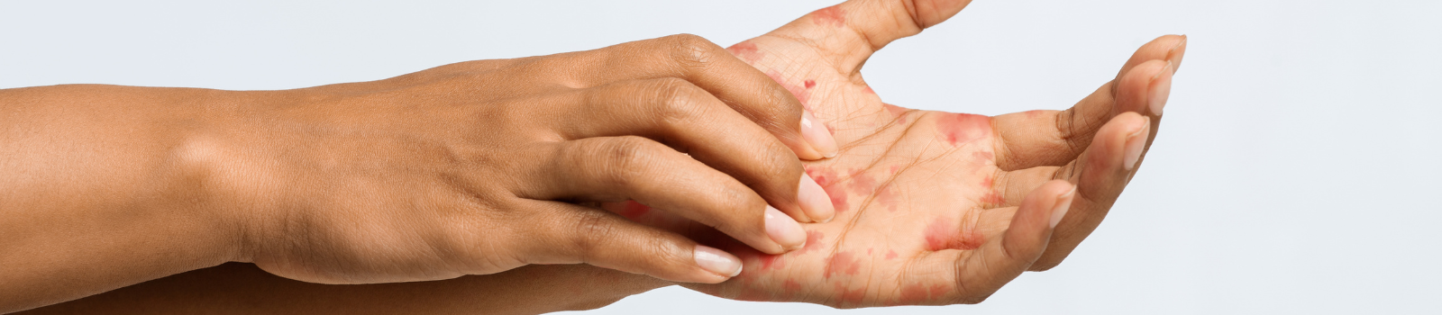 Handeczeem | Tips tegen de roodheid, jeuk en droogheid