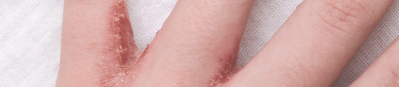 Blaasjes eczeem | Oorzaak en behandeling | Boots Apotheek