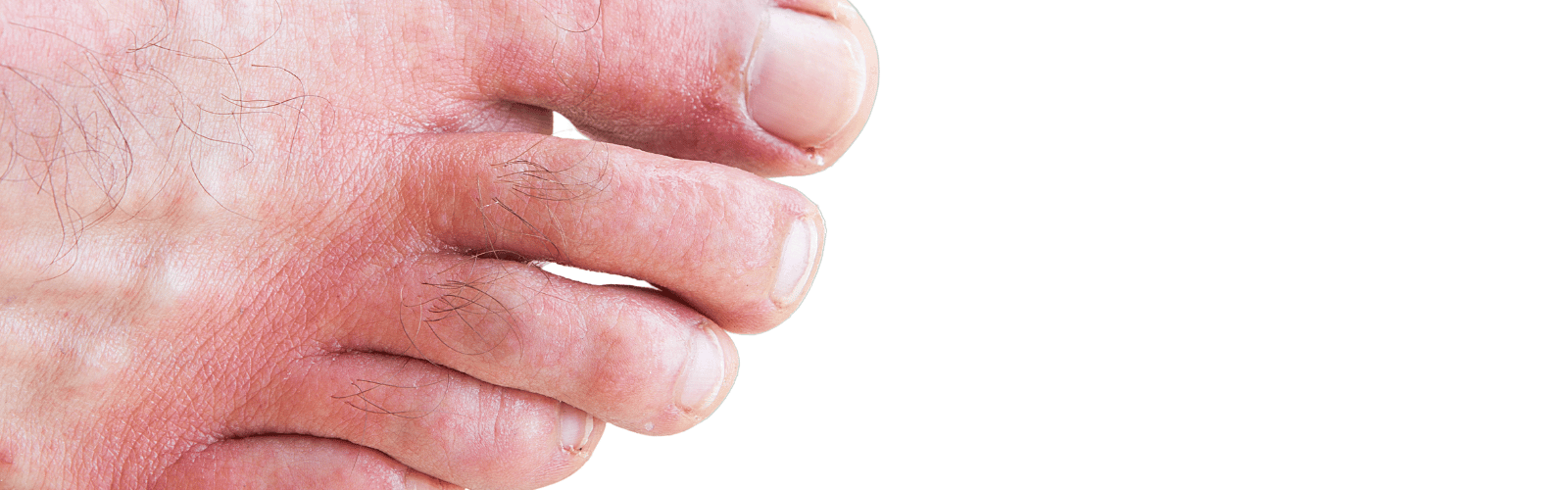 Voet eczeem | Oorzaak en onze tips